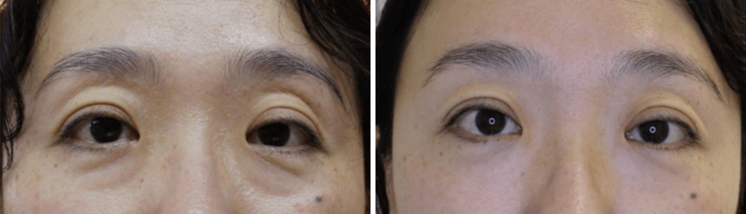 SmoothEye | Vancouver Medi Spa